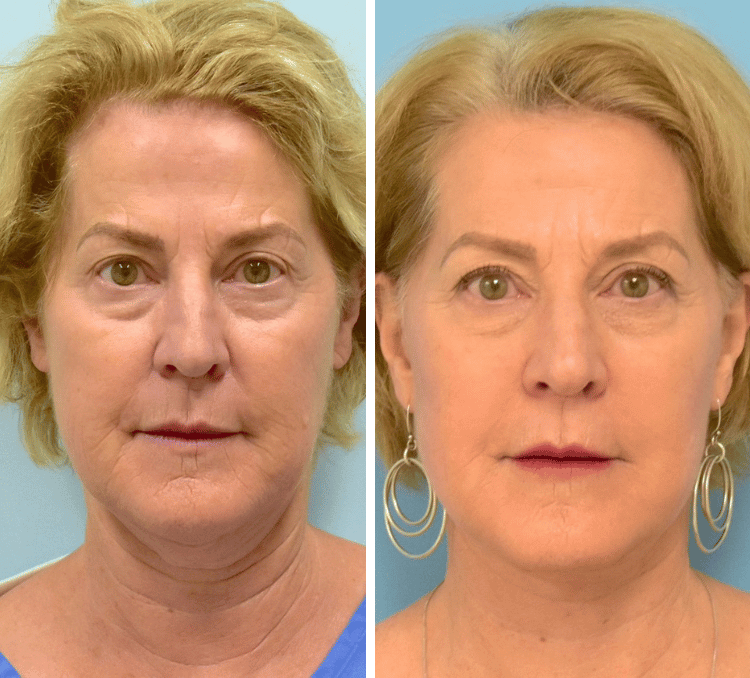 Facelift Surgery Before and After – London Plastic Surgery & Advanced ...