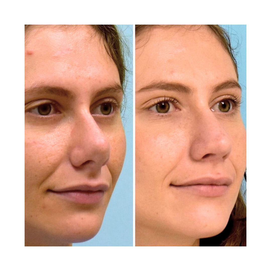 Rhinoplasty (Nose) in London, Ontario | London Plastic Surgery – London ...