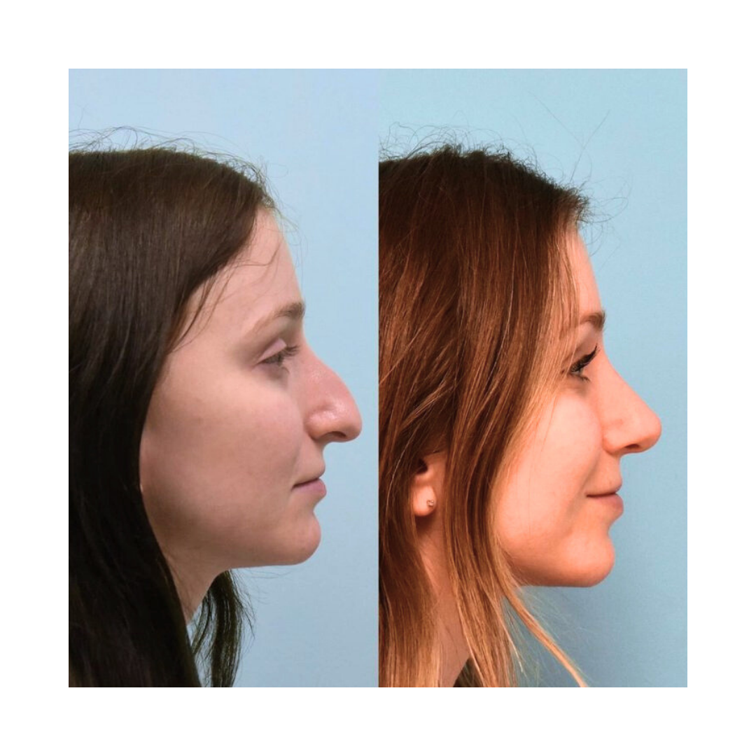Rhinoplasty (Nose) in London, Ontario | London Plastic Surgery – London ...