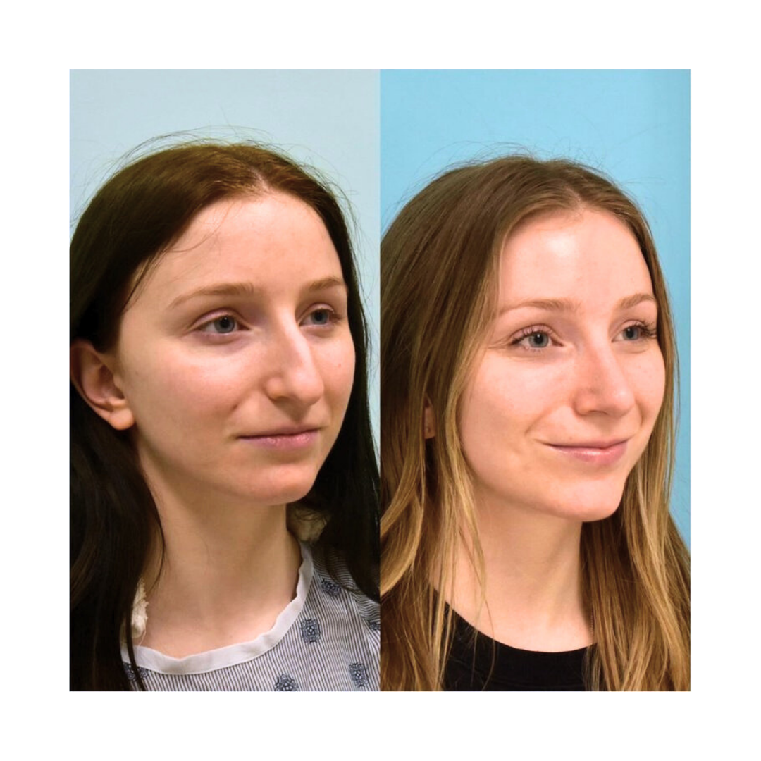 Rhinoplasty (Nose) in London, Ontario | London Plastic Surgery – London ...