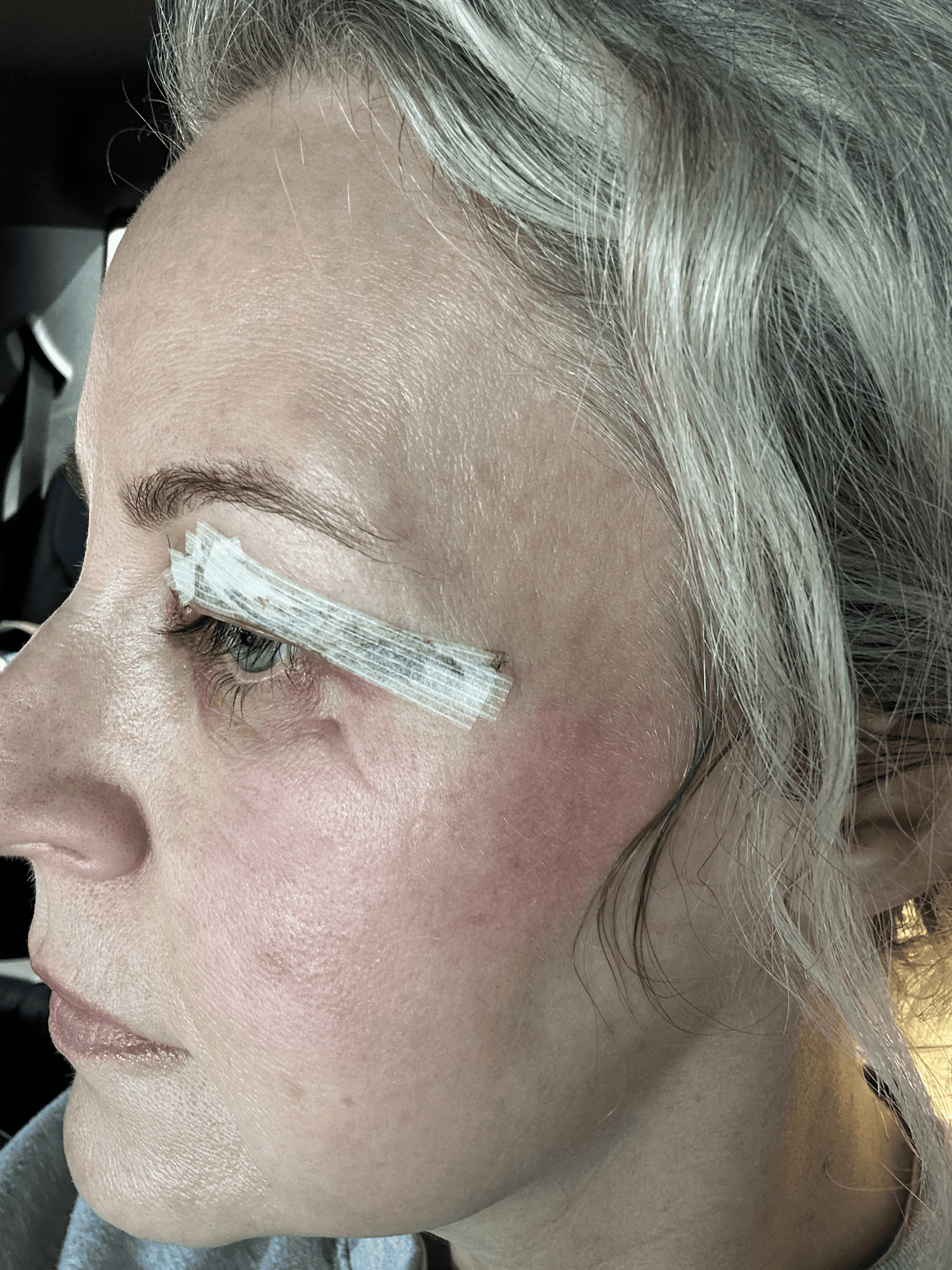 Eyelid Surgery Blepharoplasty Before and After Pictures – London ...