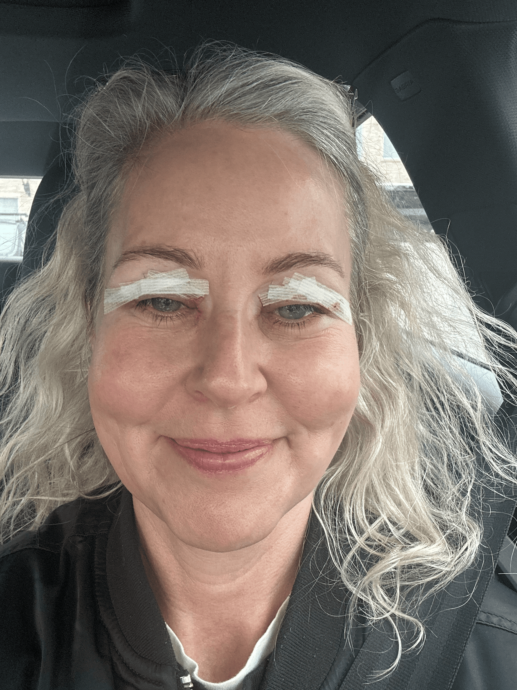 Eyelid Surgery Blepharoplasty Before and After Pictures – London ...