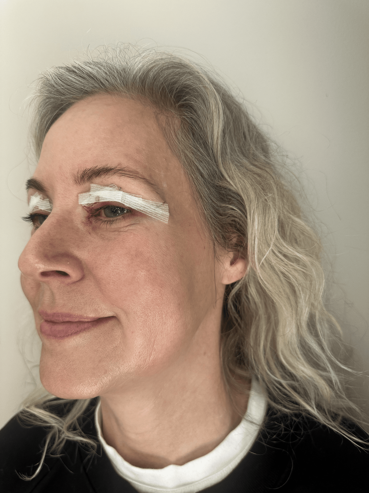 Eyelid Surgery Blepharoplasty Before and After Pictures – London ...